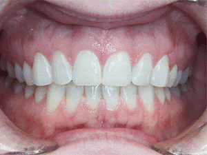 Smile Assessment - Parks Orthodontics Yorktown Va
